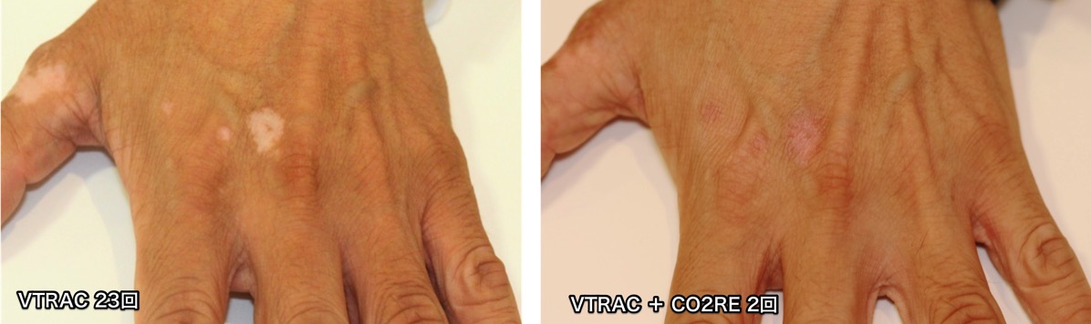 VTRAC_CO2RE.jpg | 星の原クリニック公式サイト
